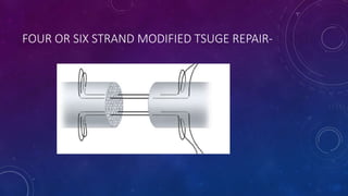 TENDON REPAIR – PRINCIPLES ^0 TYPES-1.pptx