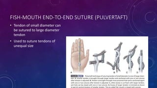 TENDON REPAIR – PRINCIPLES ^0 TYPES-1.pptx
