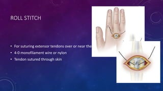 TENDON REPAIR – PRINCIPLES ^0 TYPES-1.pptx