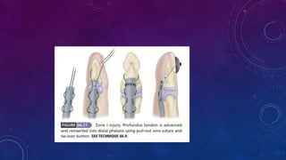 TENDON REPAIR – PRINCIPLES ^0 TYPES-1.pptx