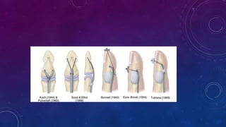 TENDON REPAIR – PRINCIPLES ^0 TYPES-1.pptx