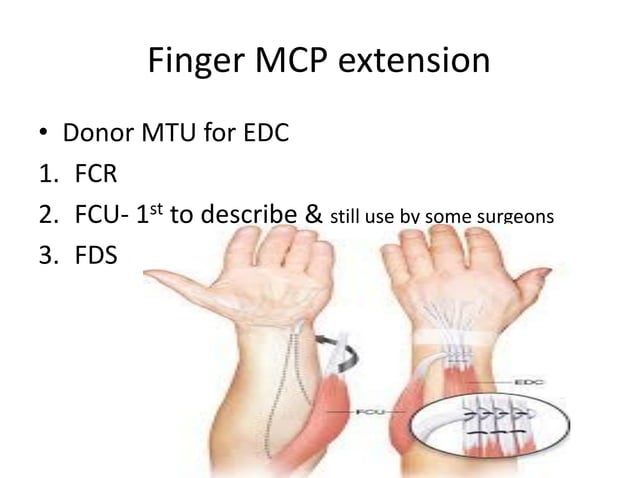 Principles of Tendon transfer and basics of tendon transfer for radial ...