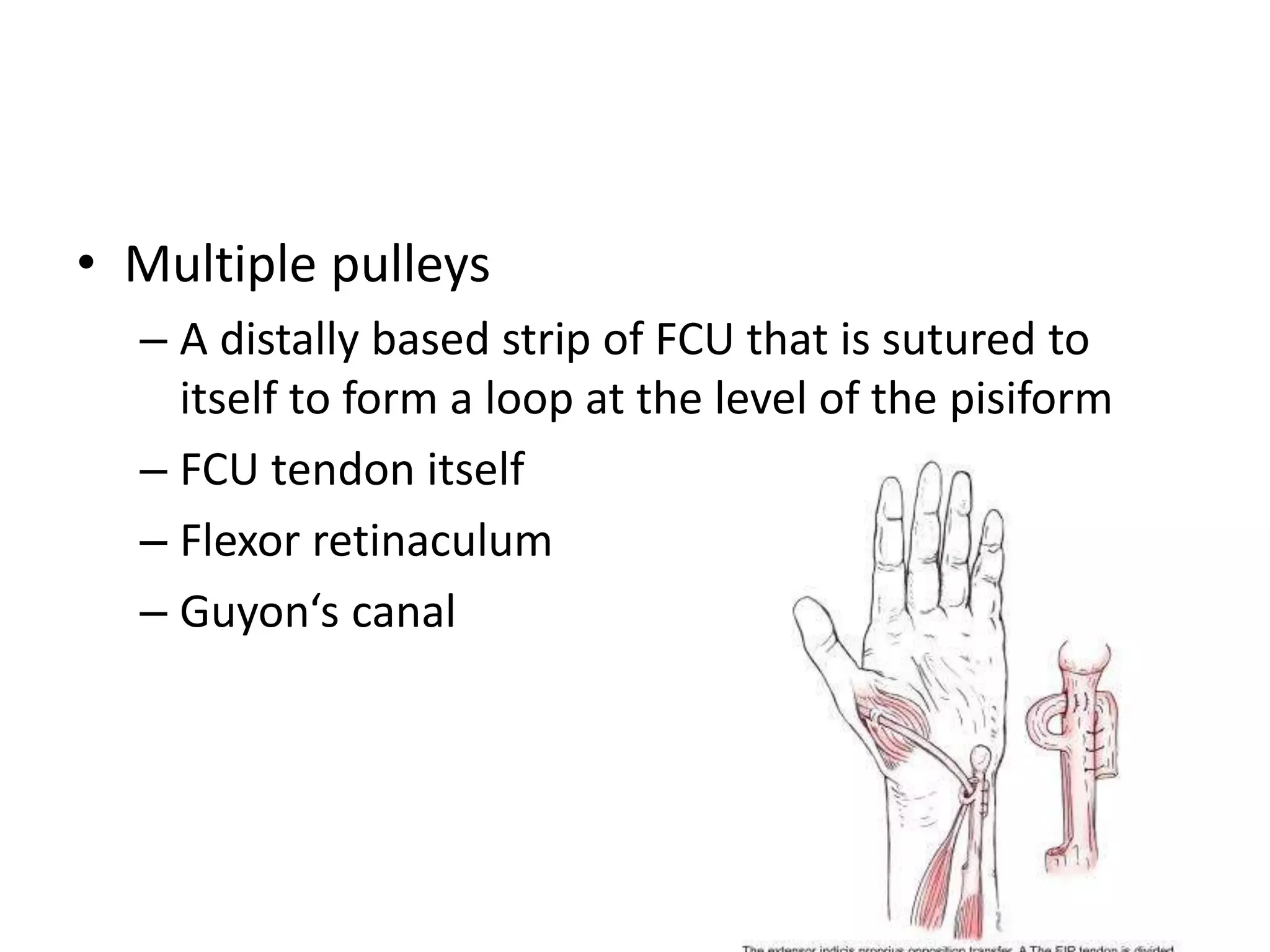 Tendon transfer- principles and techniques | PPTX