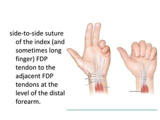 Tendon transfer- principles and techniques | PPTX