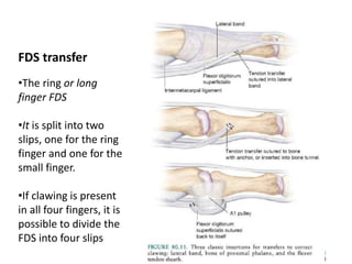 Tendon transfer- principles and techniques | PPTX