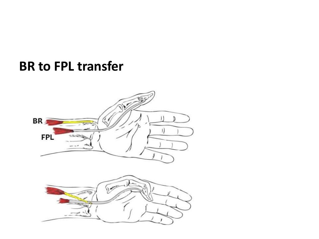 Tendon transfer- principles and techniques