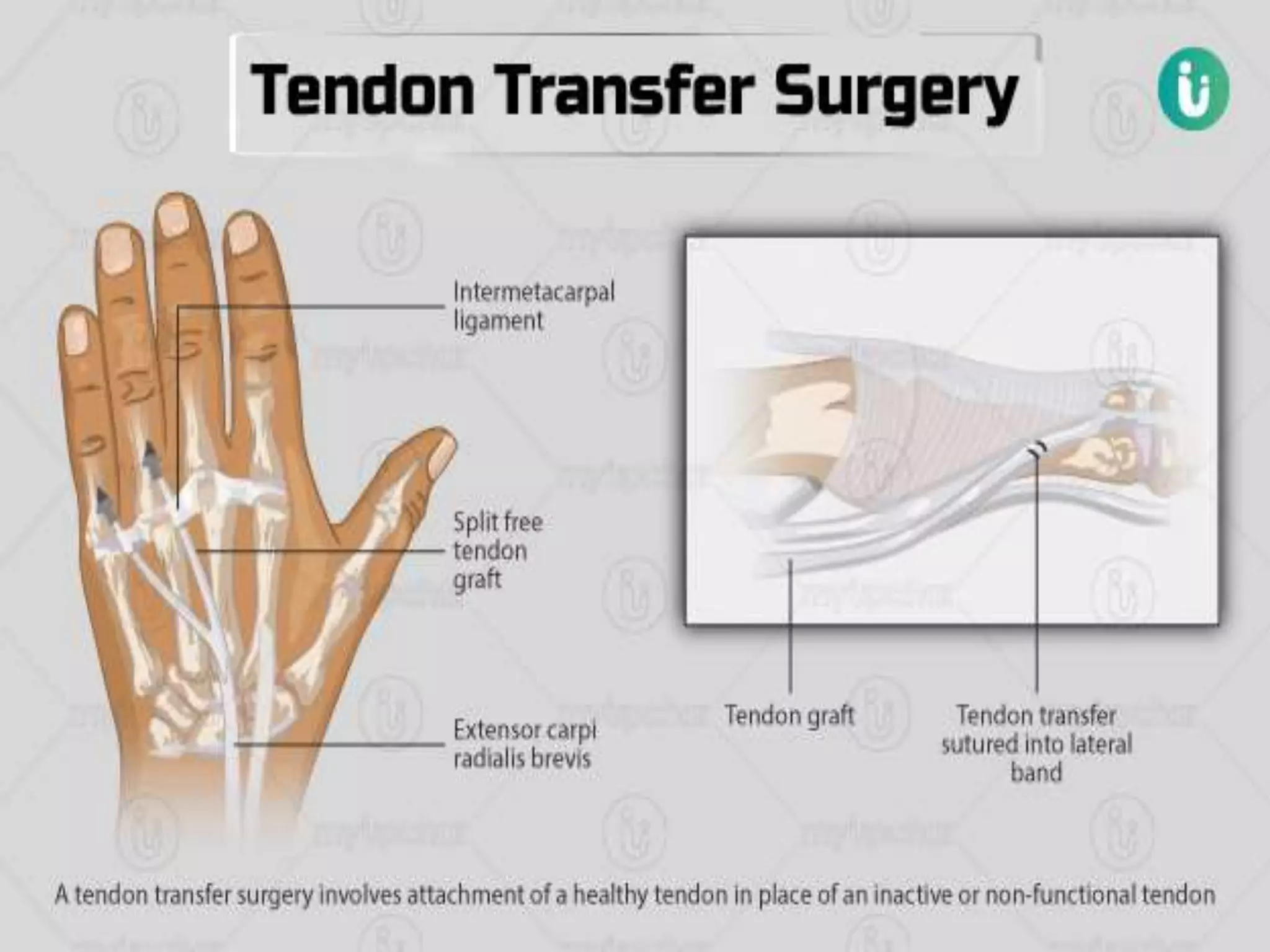 Tendon transfer.pptx
