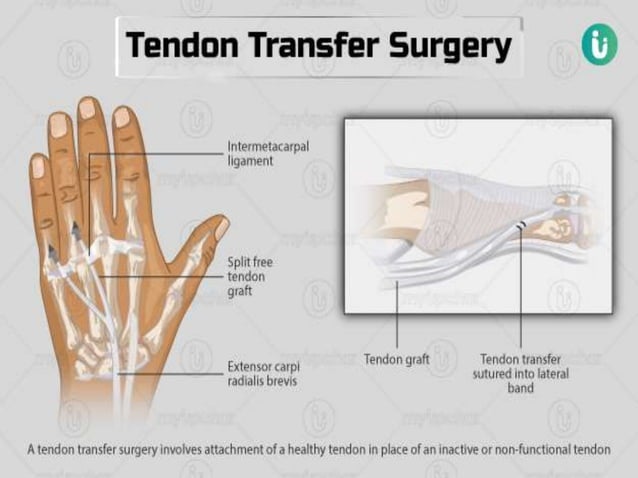 Tendon transfer.pptx | Death, Injury, or Military Conflict | Sensitive ...