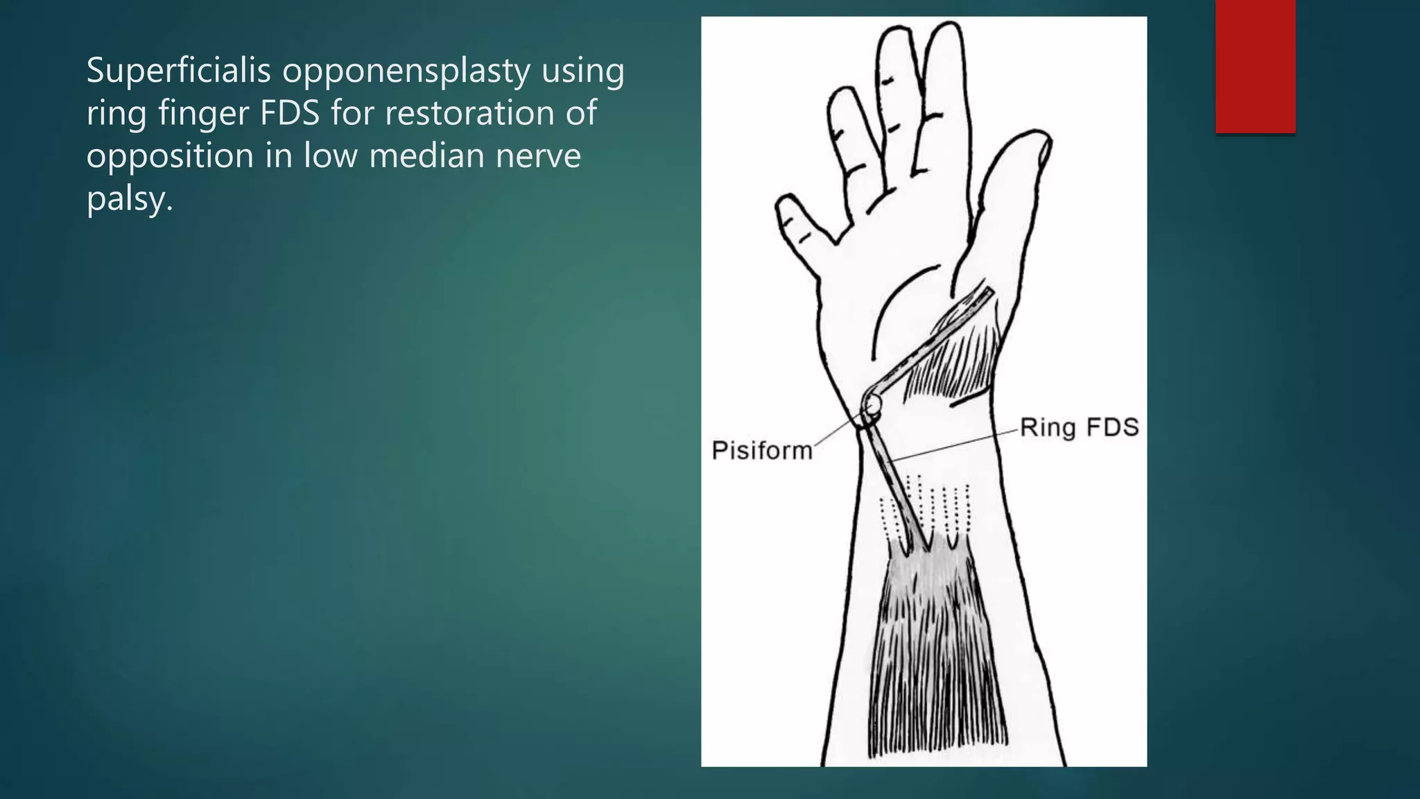 MEDIAN NERVE PALSY AND TENDON TRANSFERS | PPTX