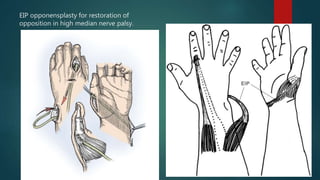MEDIAN NERVE PALSY AND TENDON TRANSFERS | PPTX