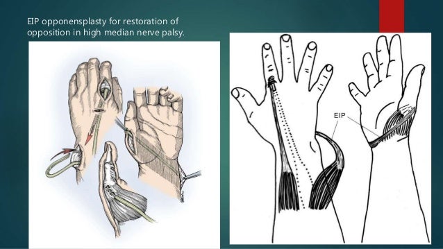 MEDIAN NERVE PALSY AND TENDON TRANSFERS