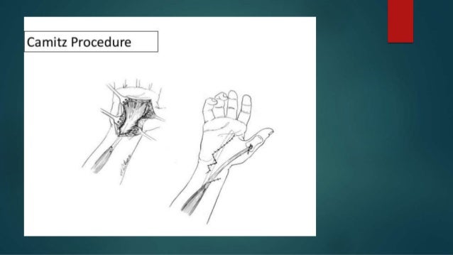 MEDIAN NERVE PALSY AND TENDON TRANSFERS
