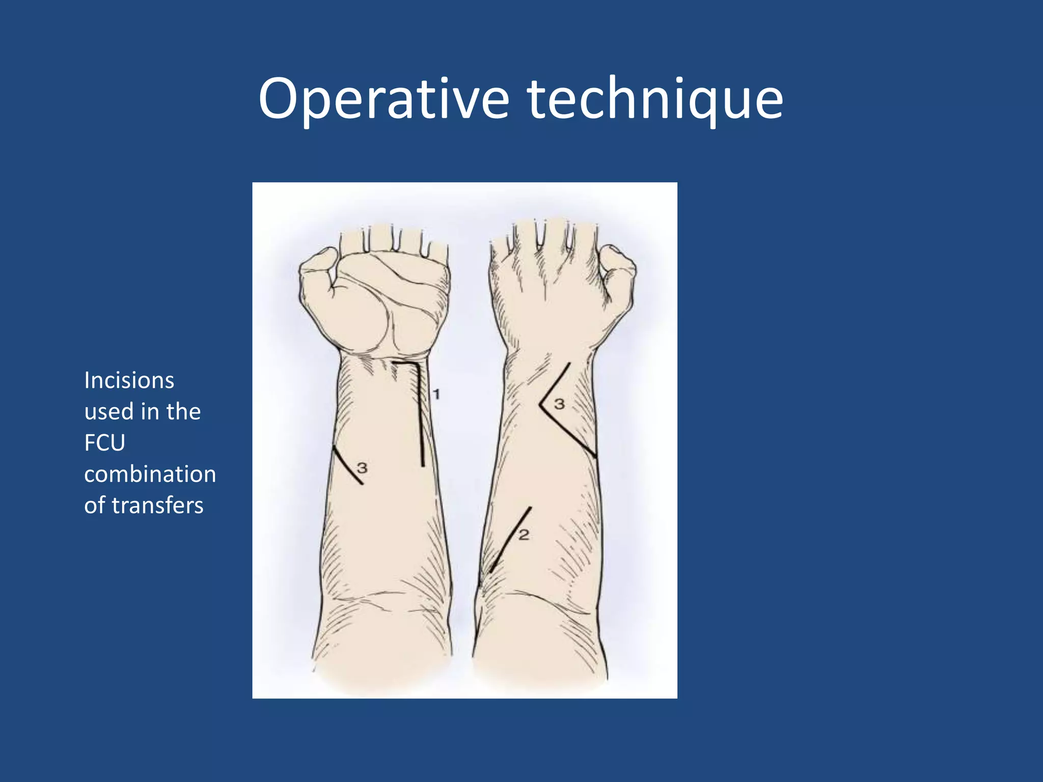 Tendon transfer for radial nerve palsy | PPTX