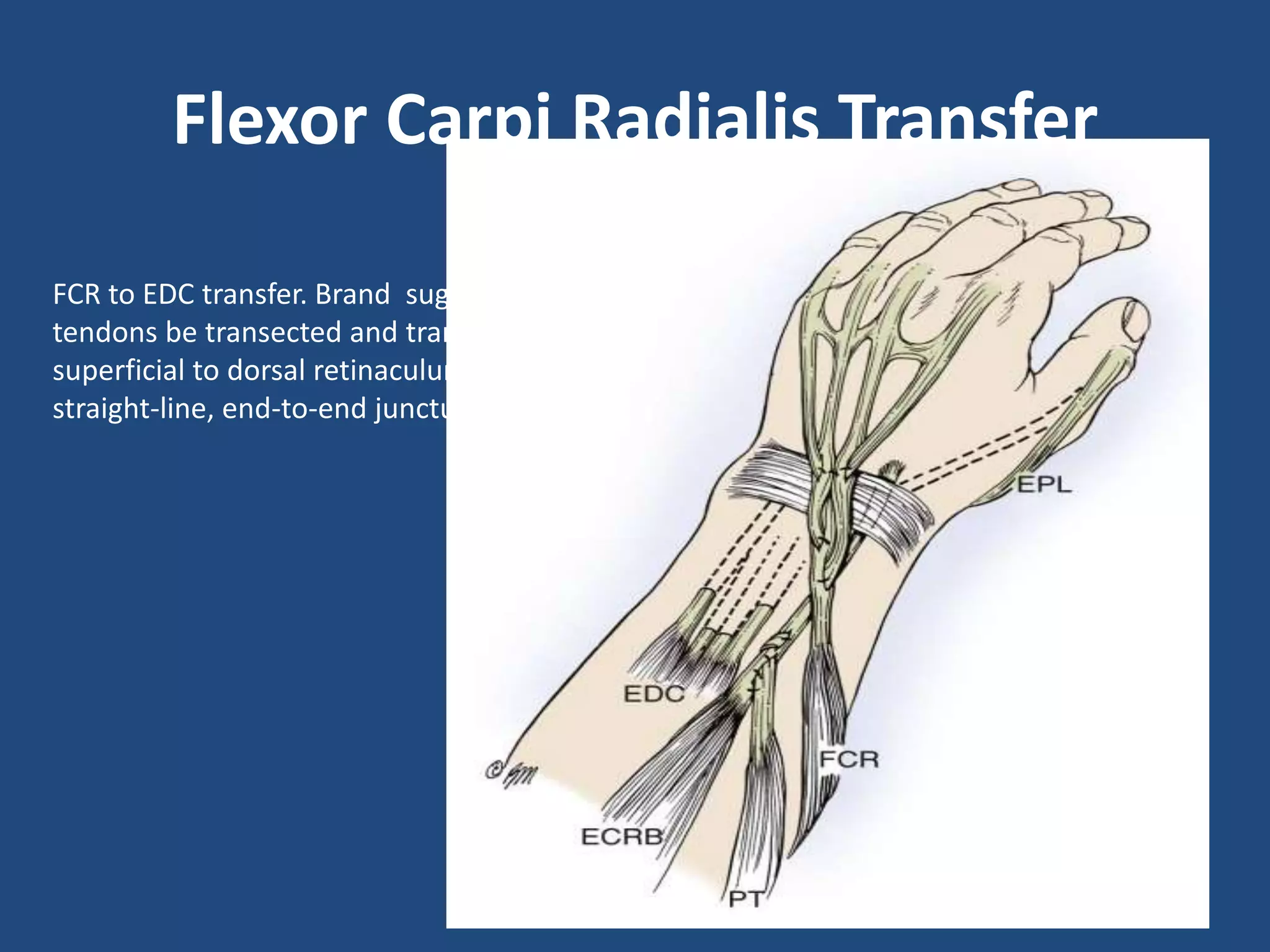 Tendon transfer for radial nerve palsy | PPTX