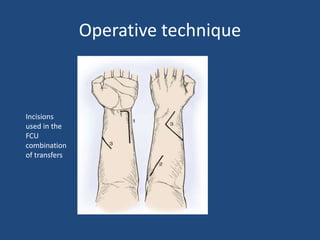 Tendon transfer for radial nerve palsy | PPTX