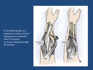 Tendon transfer for radial nerve palsy | PPTX