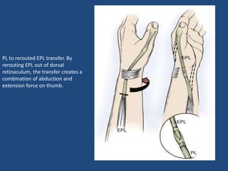 Tendon transfer for radial nerve palsy | PPTX
