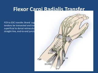 Tendon transfer for radial nerve palsy | PPTX
