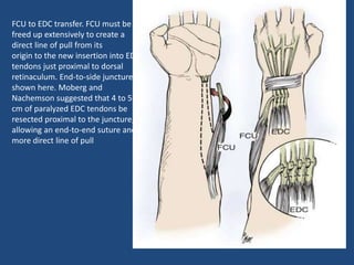 Tendon transfer for radial nerve palsy | PPT