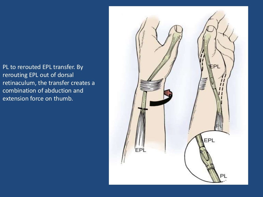 Tendon transfer for radial nerve palsy
