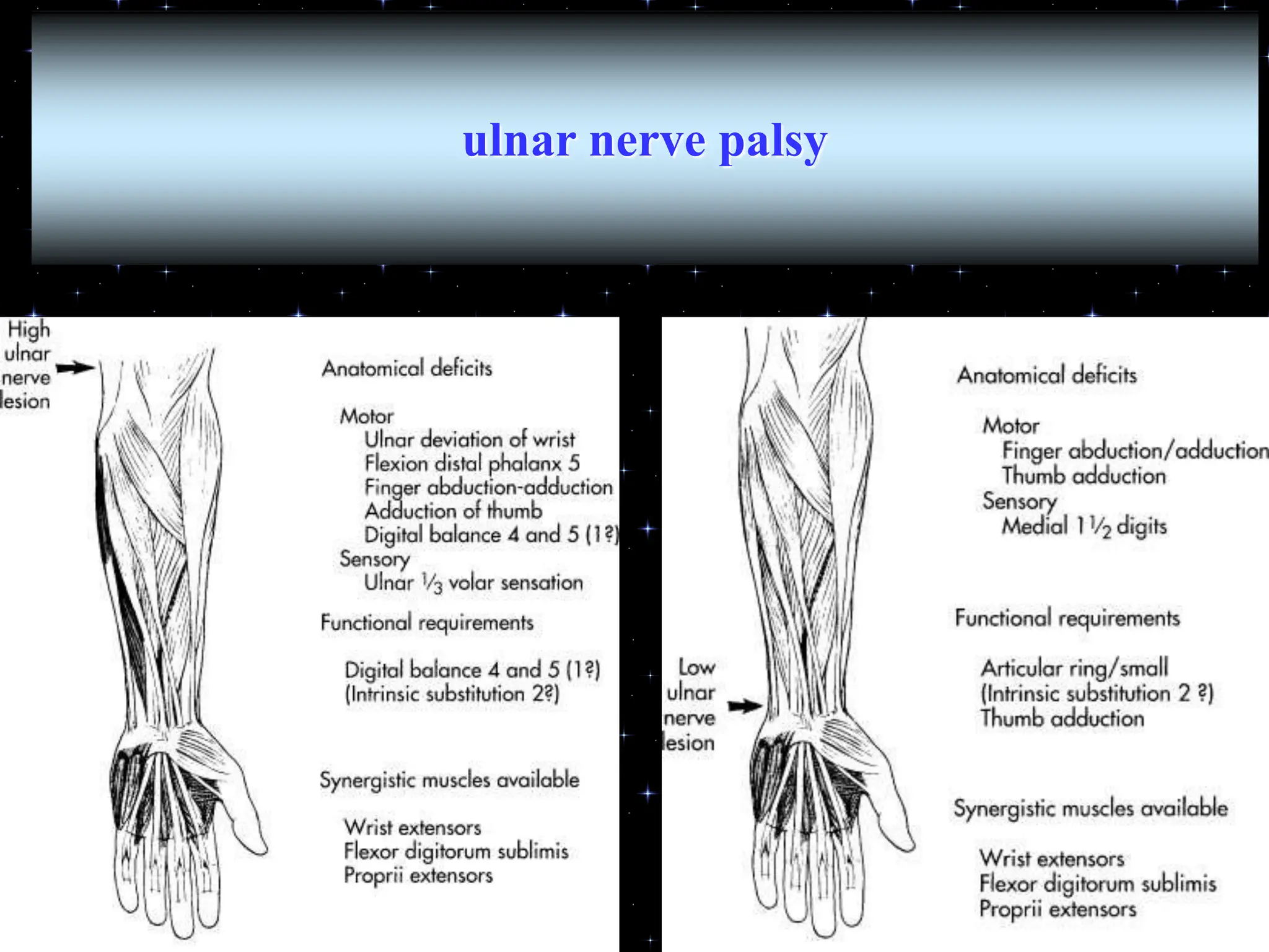 TENDON TRANSFER FOR ULNAR NERVE PALSY ppt | PPTX
