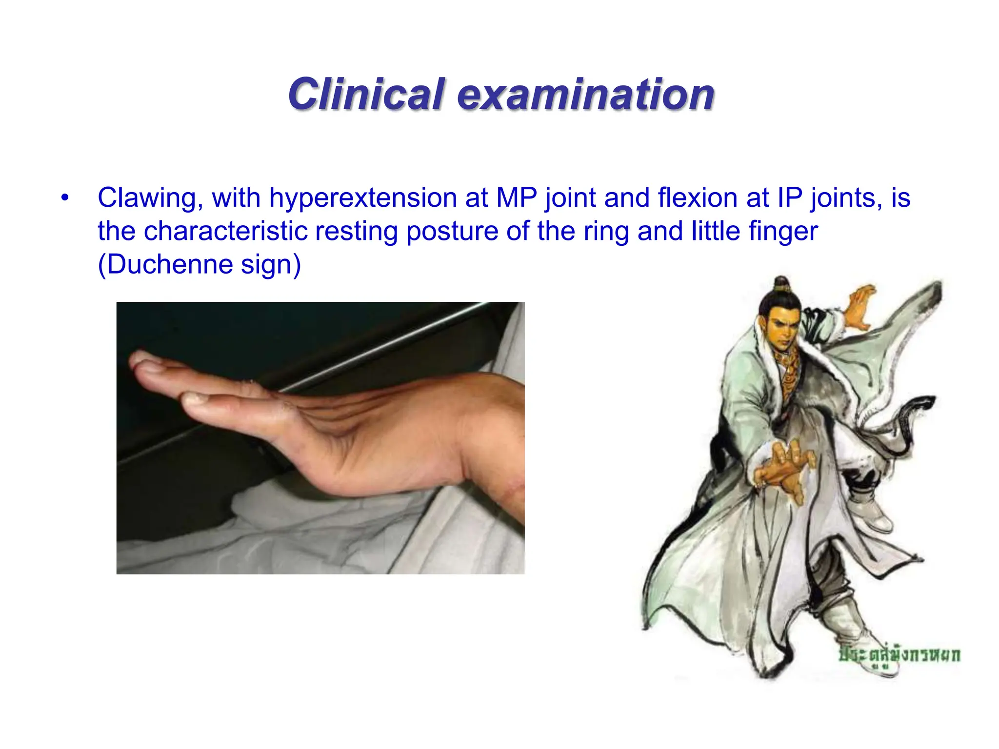 TENDON TRANSFER FOR ULNAR NERVE PALSY ppt | PPTX