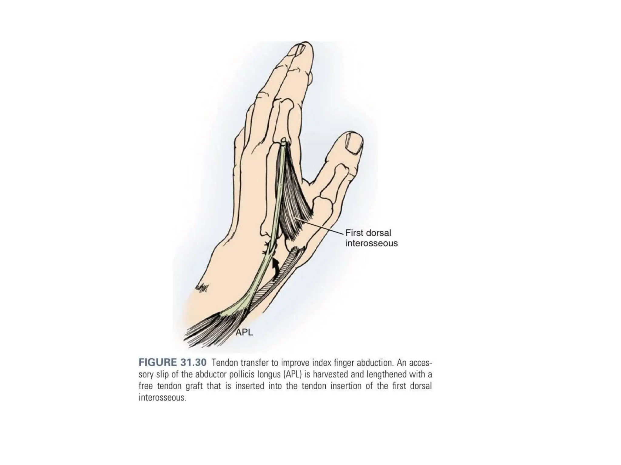 TENDON TRANSFER FOR ULNAR NERVE PALSY ppt | PPTX