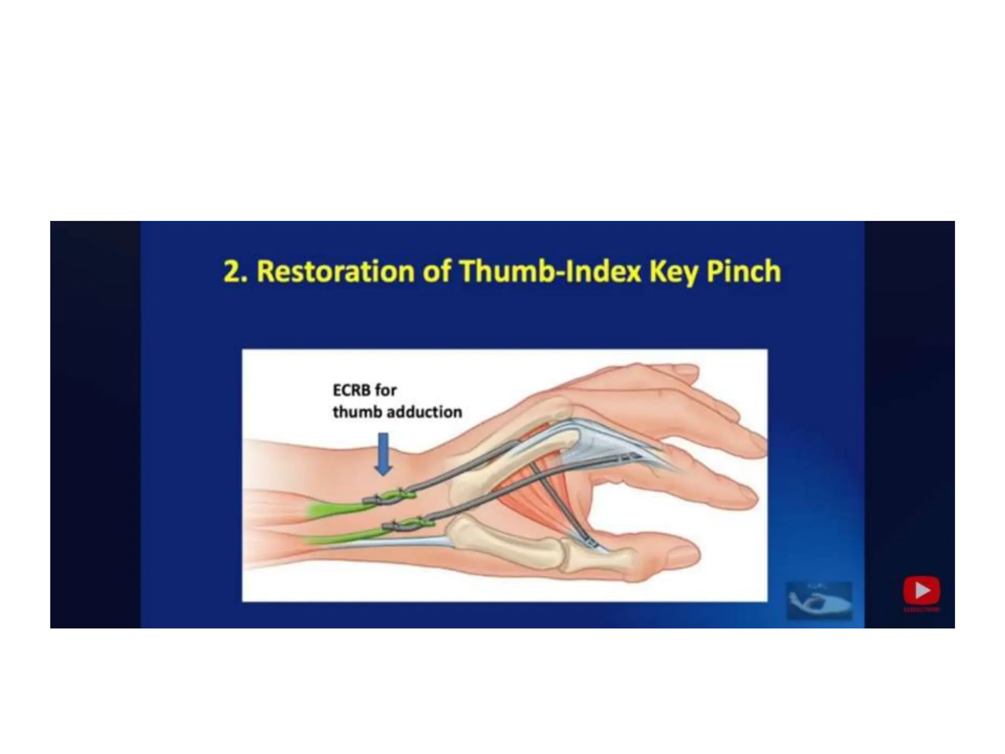 TENDON TRANSFER FOR ULNAR NERVE PALSY ppt | PPTX