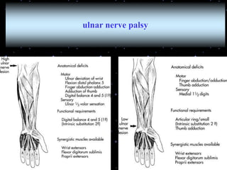 TENDON TRANSFER FOR ULNAR NERVE PALSY ppt | PPTX
