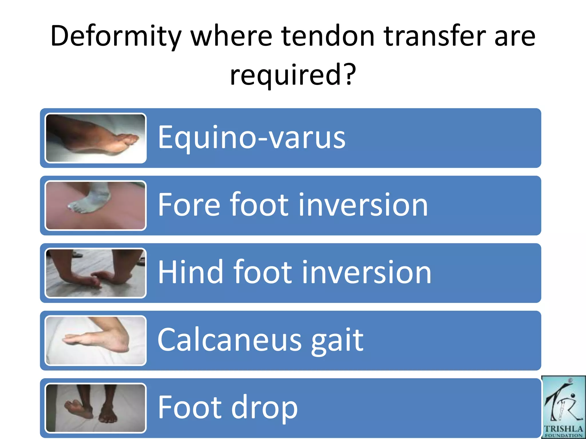 Tendon transfer in neuro-muscular foot | PPTX
