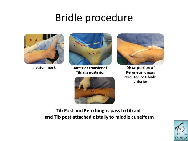 Tendon transfer in neuro-muscular foot