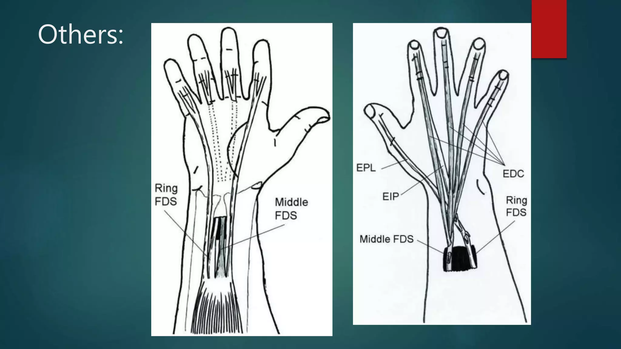 RADIAL NERVE PALSY AND TENDON TRANSFER | PPTX