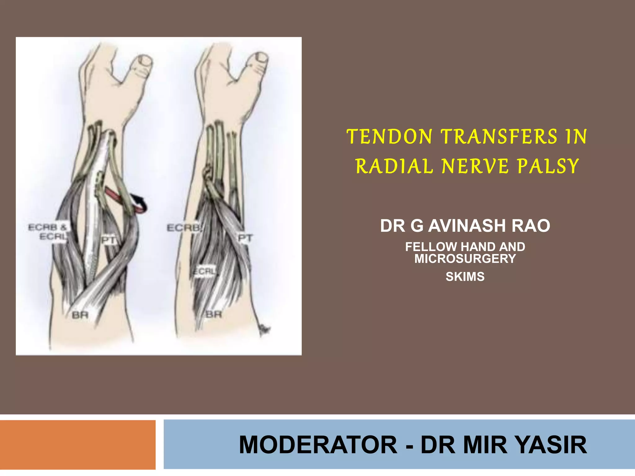 Tendon transfers for radial nerve palsy | PPT