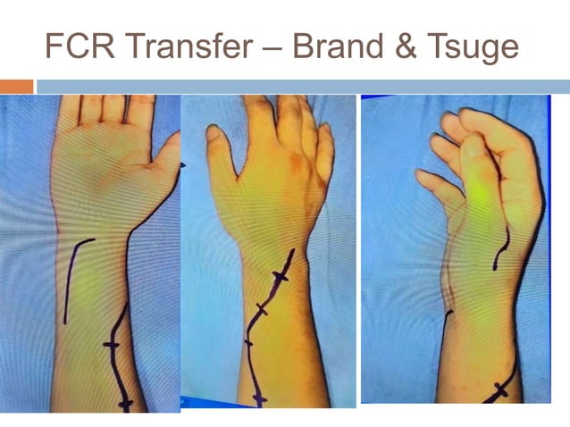 Tendon transfers for radial nerve palsy | PPT