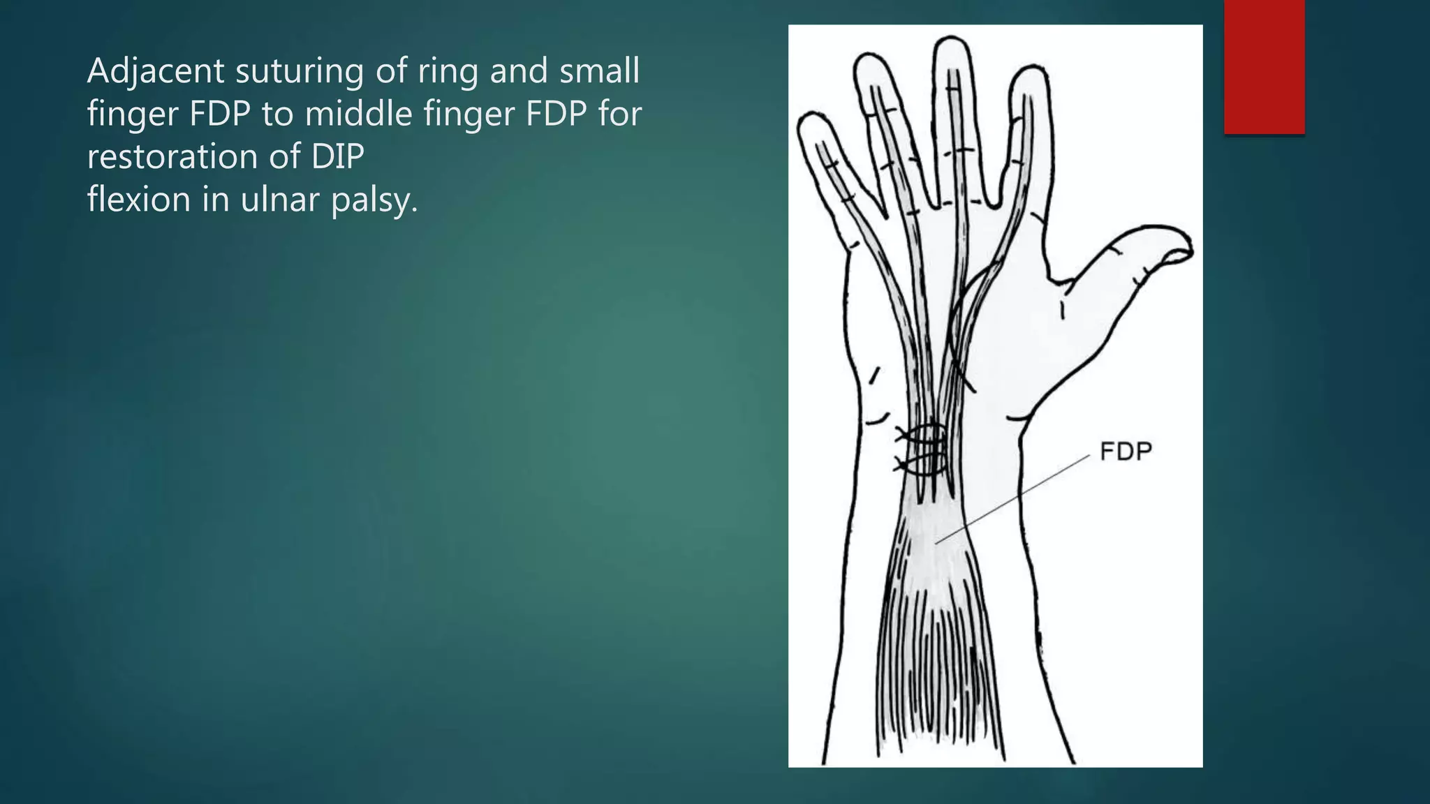 ULNAR NERVE PALSY AND TENDON TRANSFERS | PPTX | Death, Injury, or ...