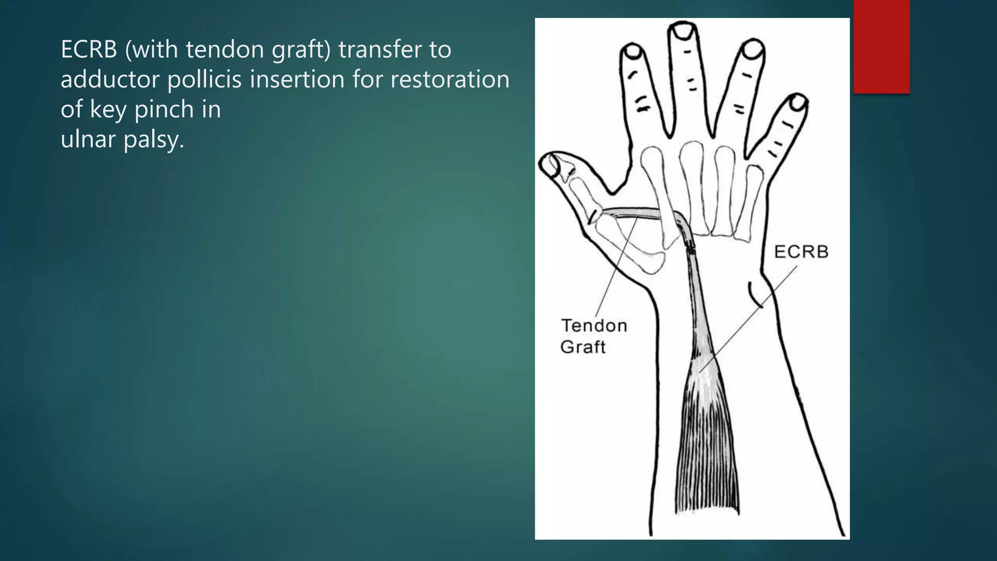 ULNAR NERVE PALSY AND TENDON TRANSFERS | PPTX