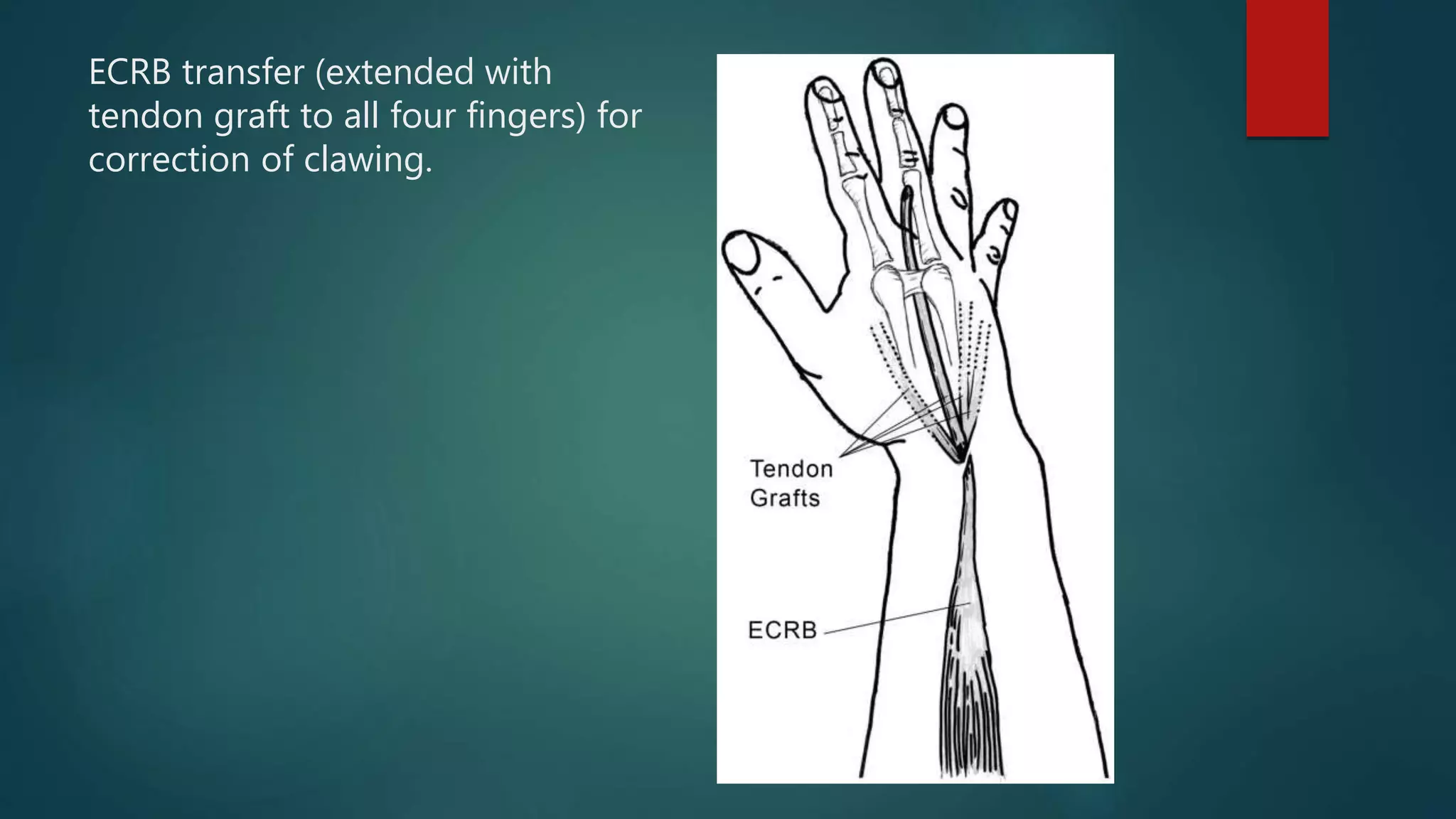ULNAR NERVE PALSY AND TENDON TRANSFERS | PPTX