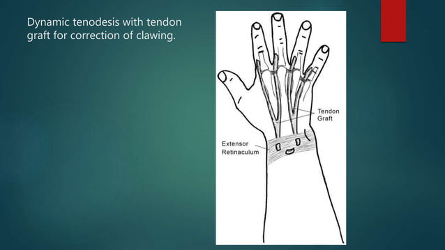 ULNAR NERVE PALSY AND TENDON TRANSFERS | PPT
