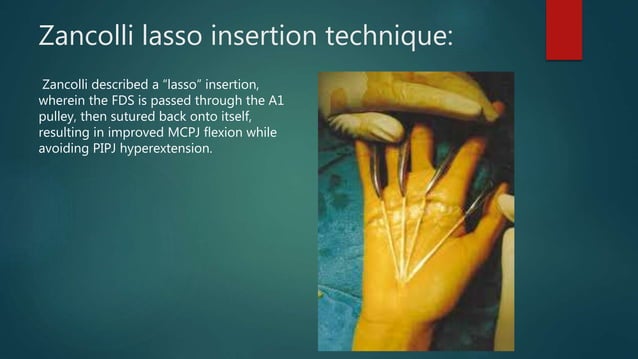 ULNAR NERVE PALSY AND TENDON TRANSFERS | PPTX | Death, Injury, or ...