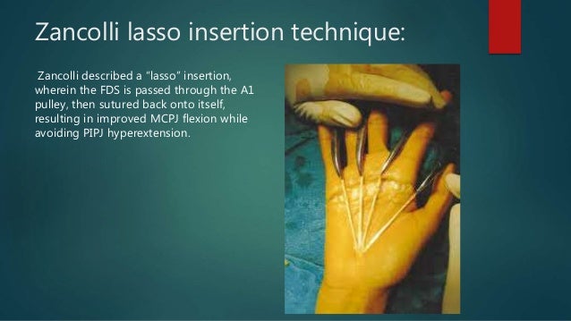 ULNAR NERVE PALSY AND TENDON TRANSFERS