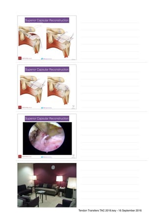 Tendon Transfers around the Shoulder | PDF