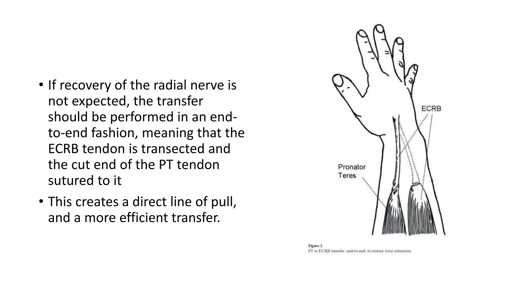 Principles of Transfer and Transfers for Radial Nerve Palsy | PPTX
