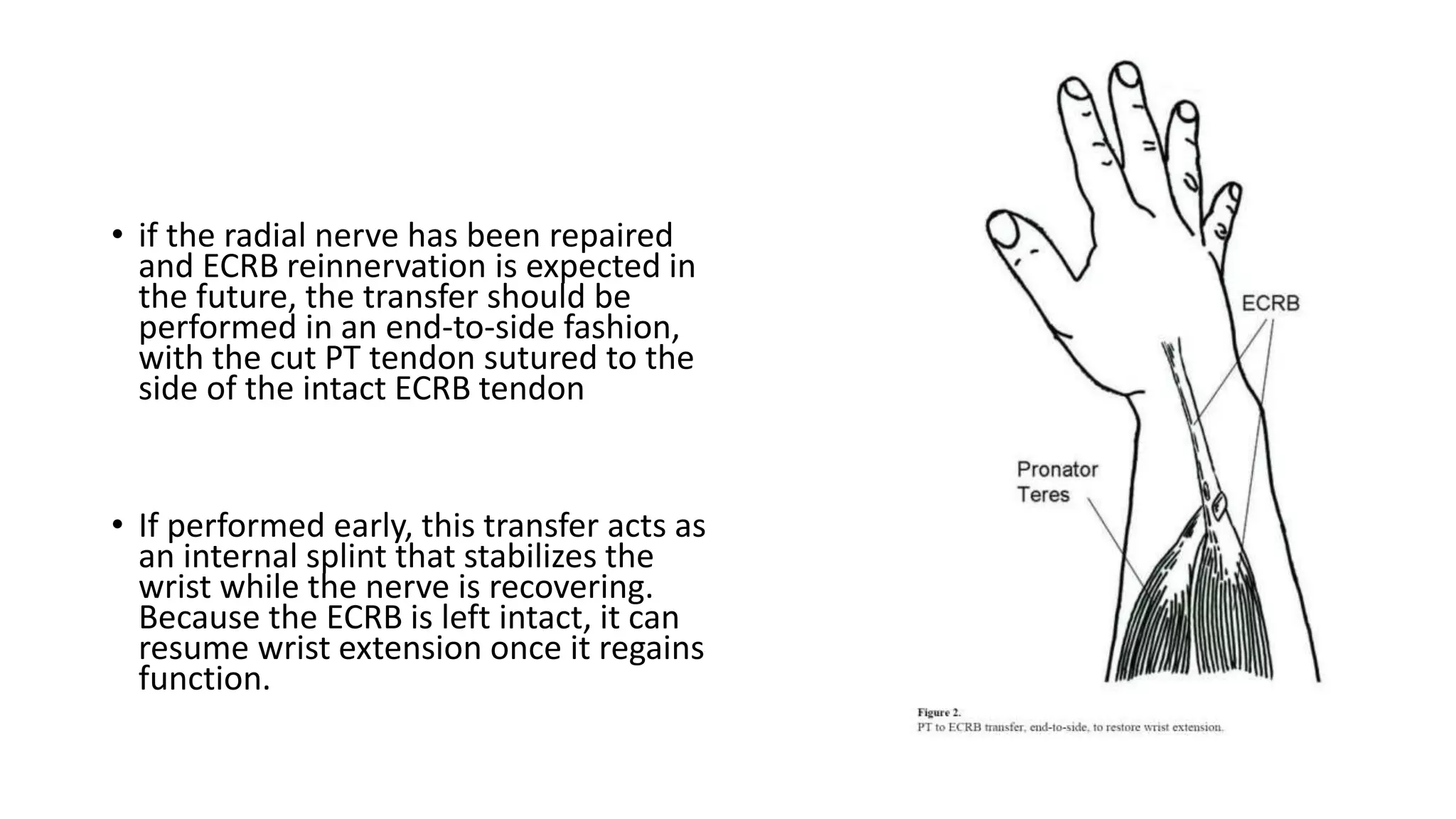 Principles of Transfer and Transfers for Radial Nerve Palsy | PPTX