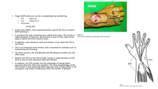 Principles of Transfer and Transfers for Radial Nerve Palsy | PPTX
