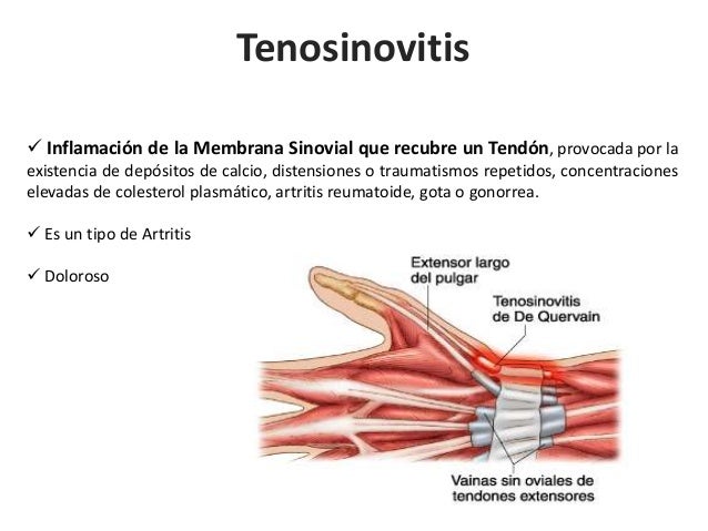 Tendosinovitis, sinovitis,artritis,artrosis