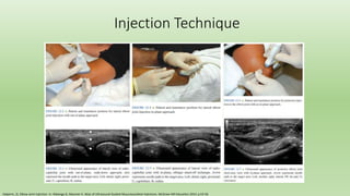 Tennis and Golfer's Elbow | PPTX