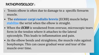 Tennis elbow | EDITED | | PPTX