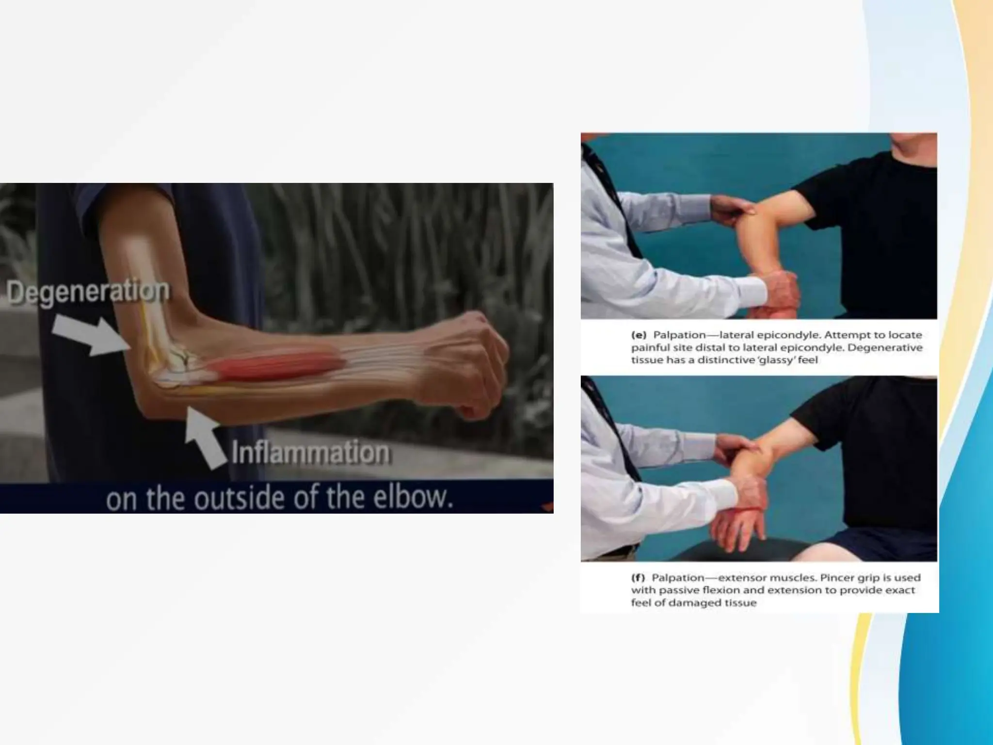 TENNIS ELBOW (Lateral Epicondylitis).pptx