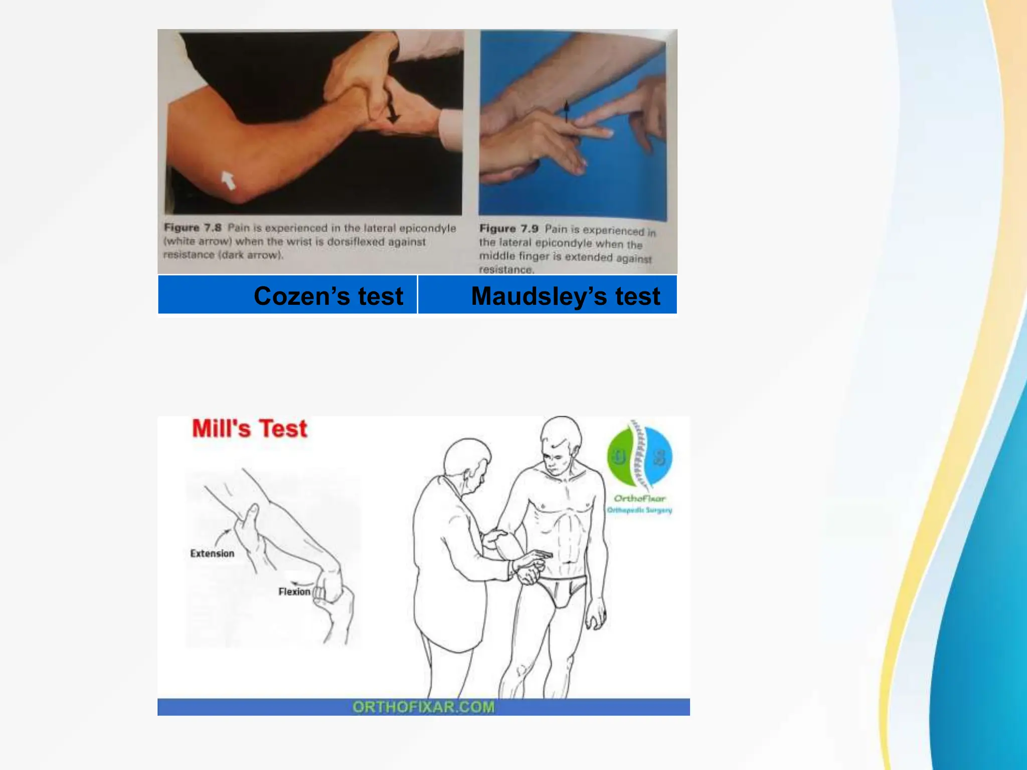 TENNIS ELBOW (Lateral Epicondylitis).pptx