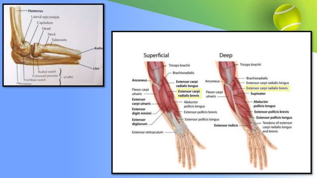 Tennis elbow (Lateral epicondylitis) Orthopaedic | PPTX